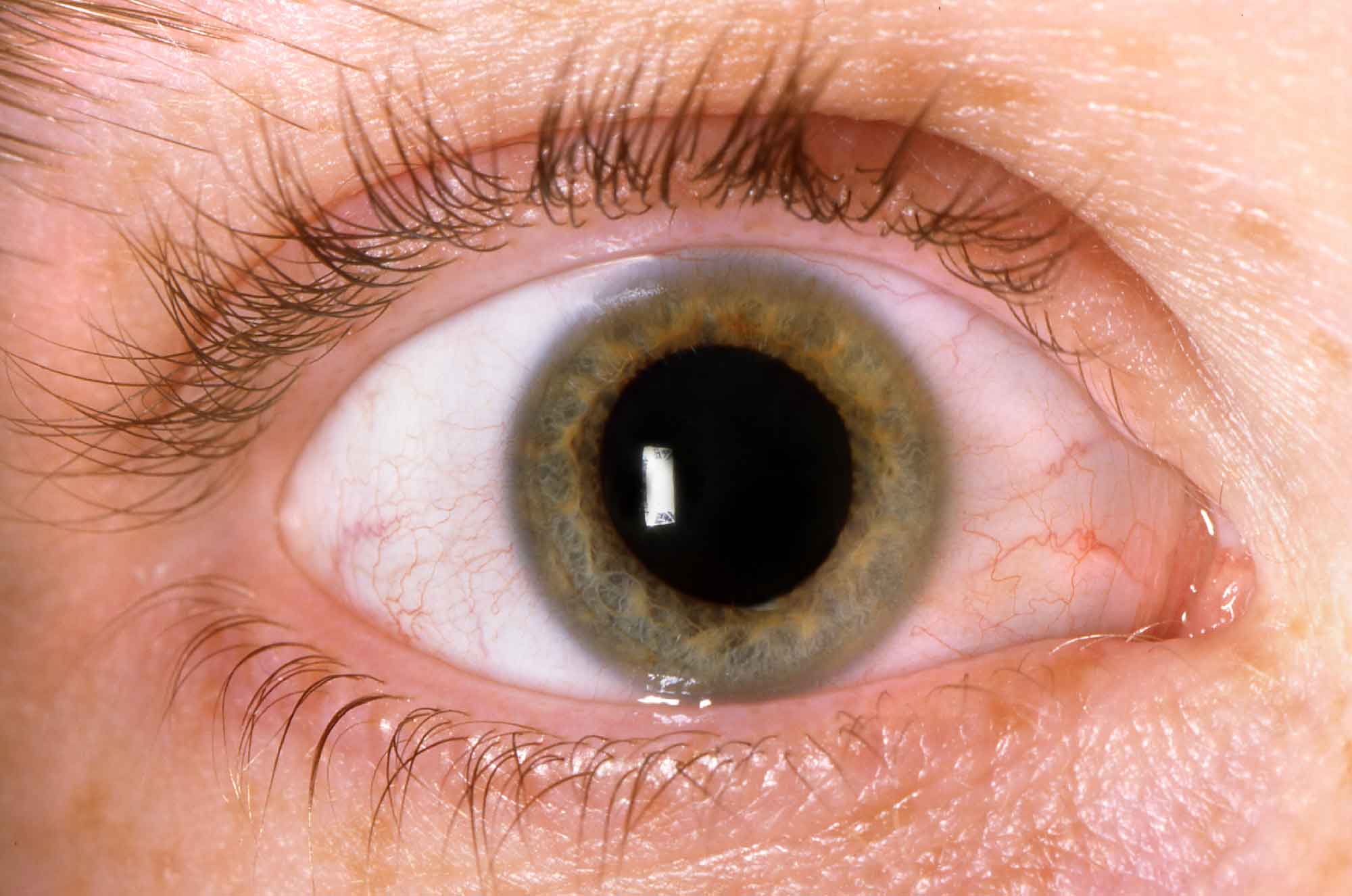 Altersbedingte Makuladegeneration (AMD) - Privatpraxis Dr. Kersten